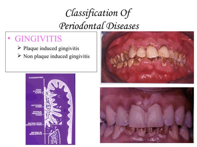 Classification of periodontal diseases | PPT