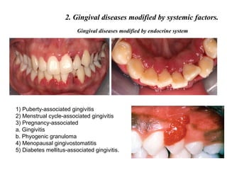 Classification of periodontal diseases | PPT