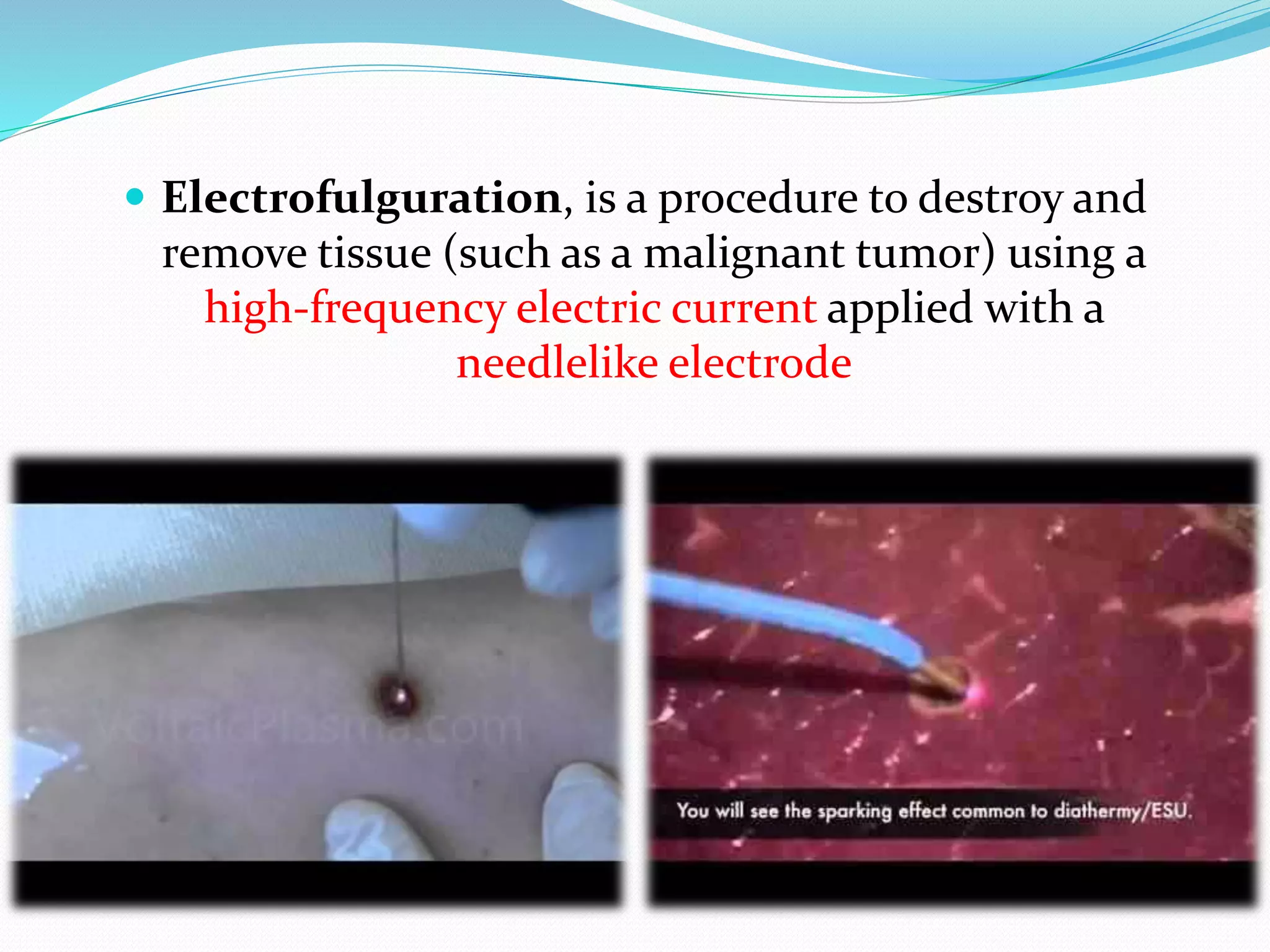 Classification of periodontal instruments | PPTX