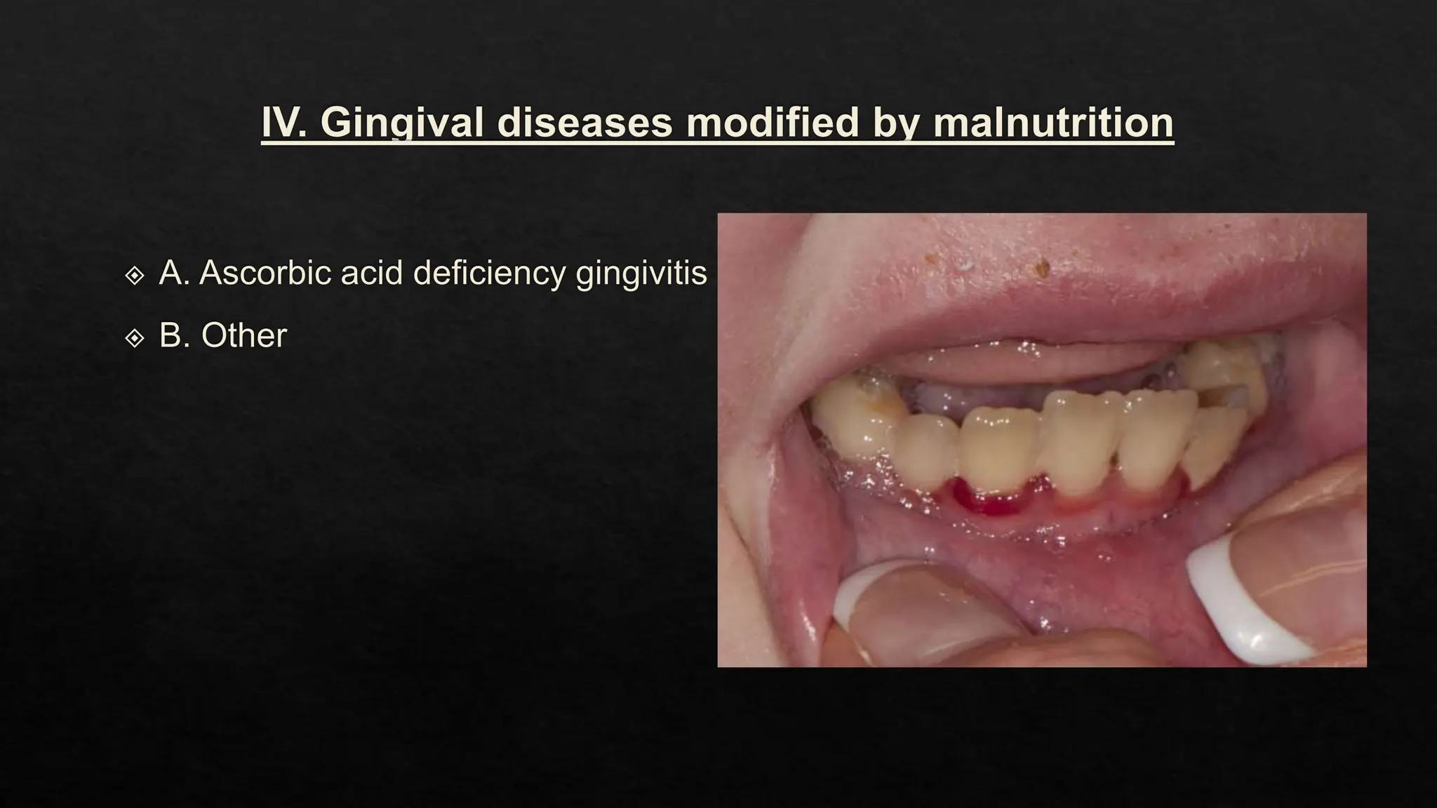 Classification of periodontitis | PPT