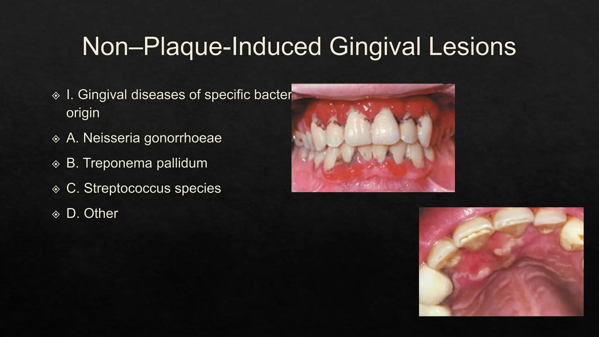 Classification of periodontitis | PPT