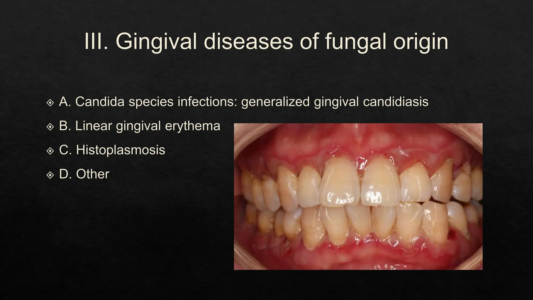Classification of periodontitis | PPT