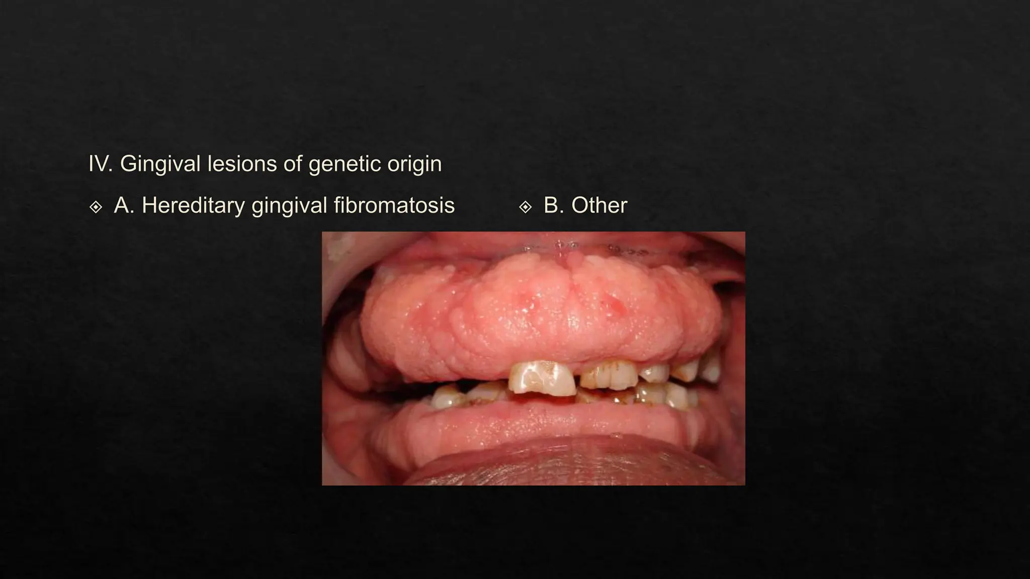 Classification of periodontitis | PPT