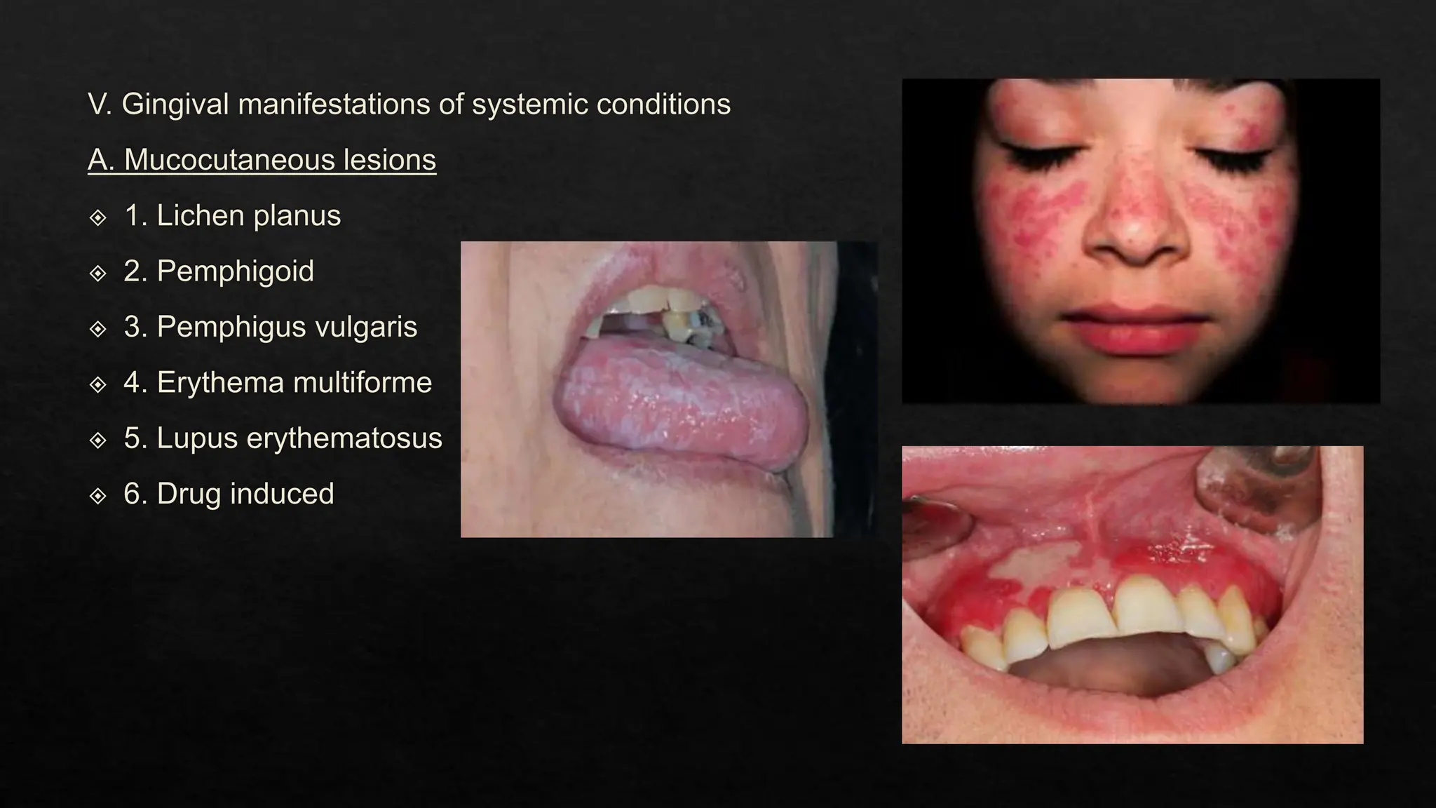 Classification of periodontitis | PPT