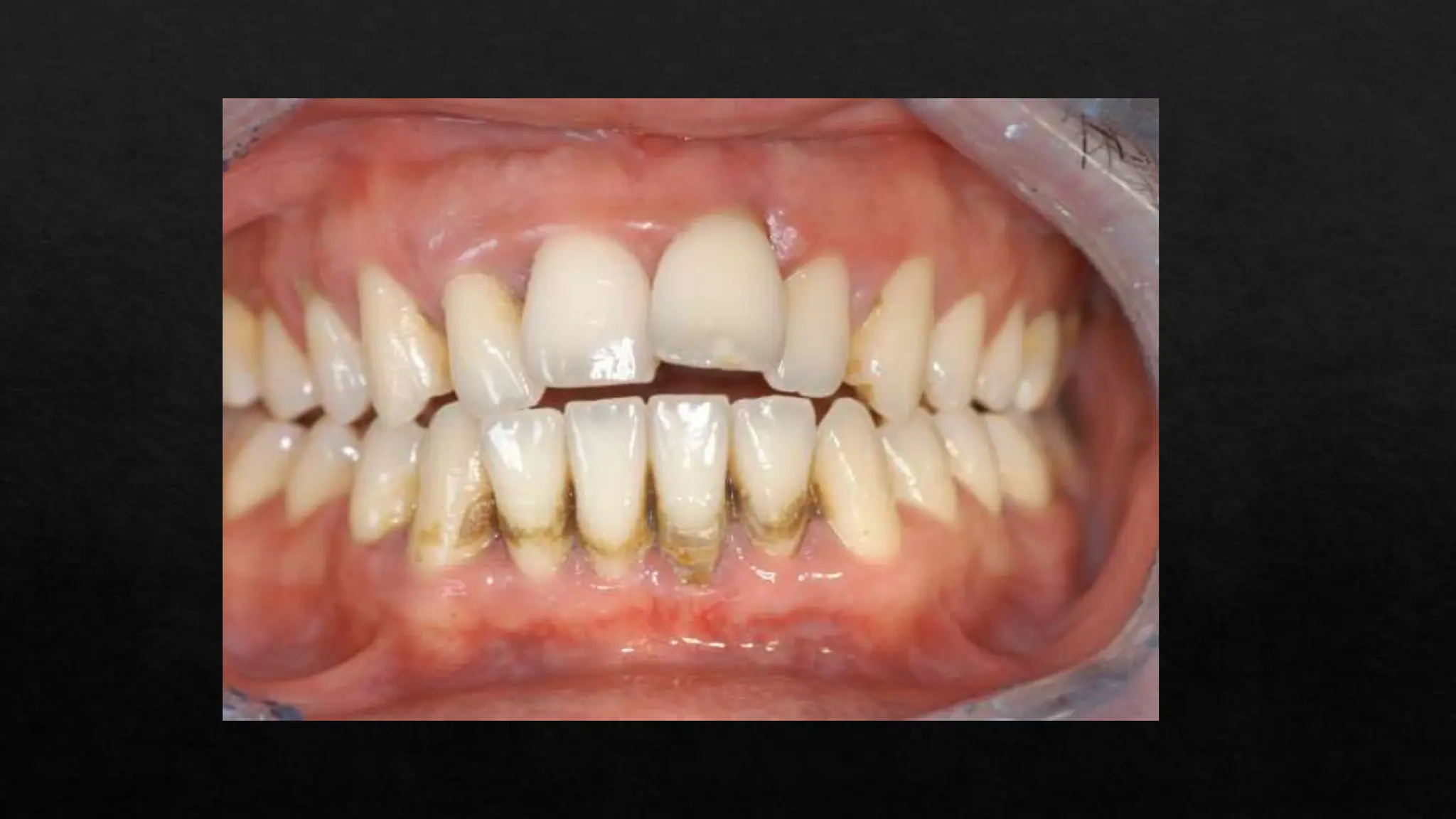 Classification of periodontitis | PPT