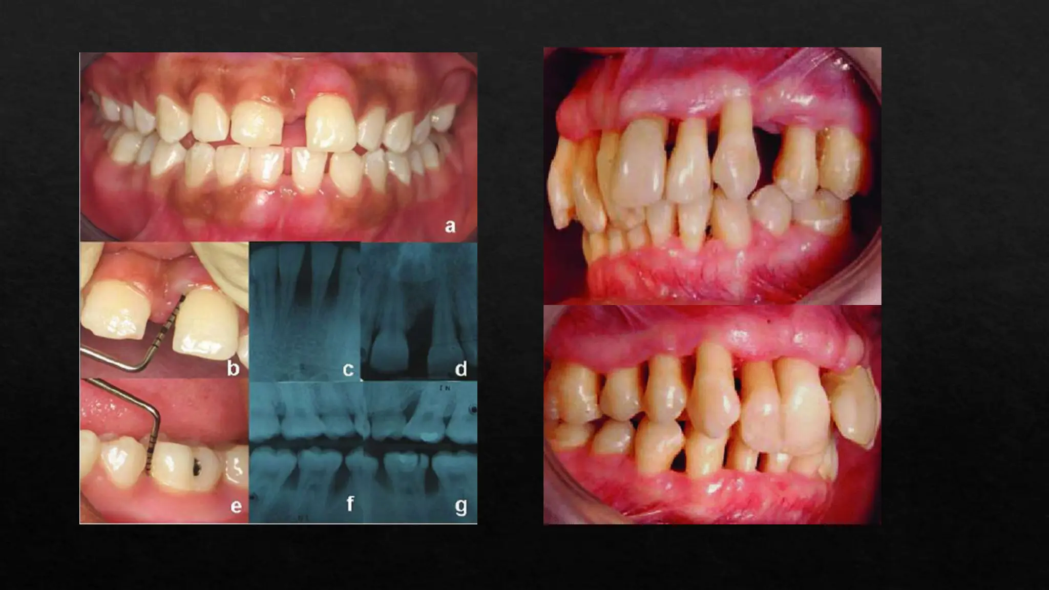Classification of periodontitis | PPT