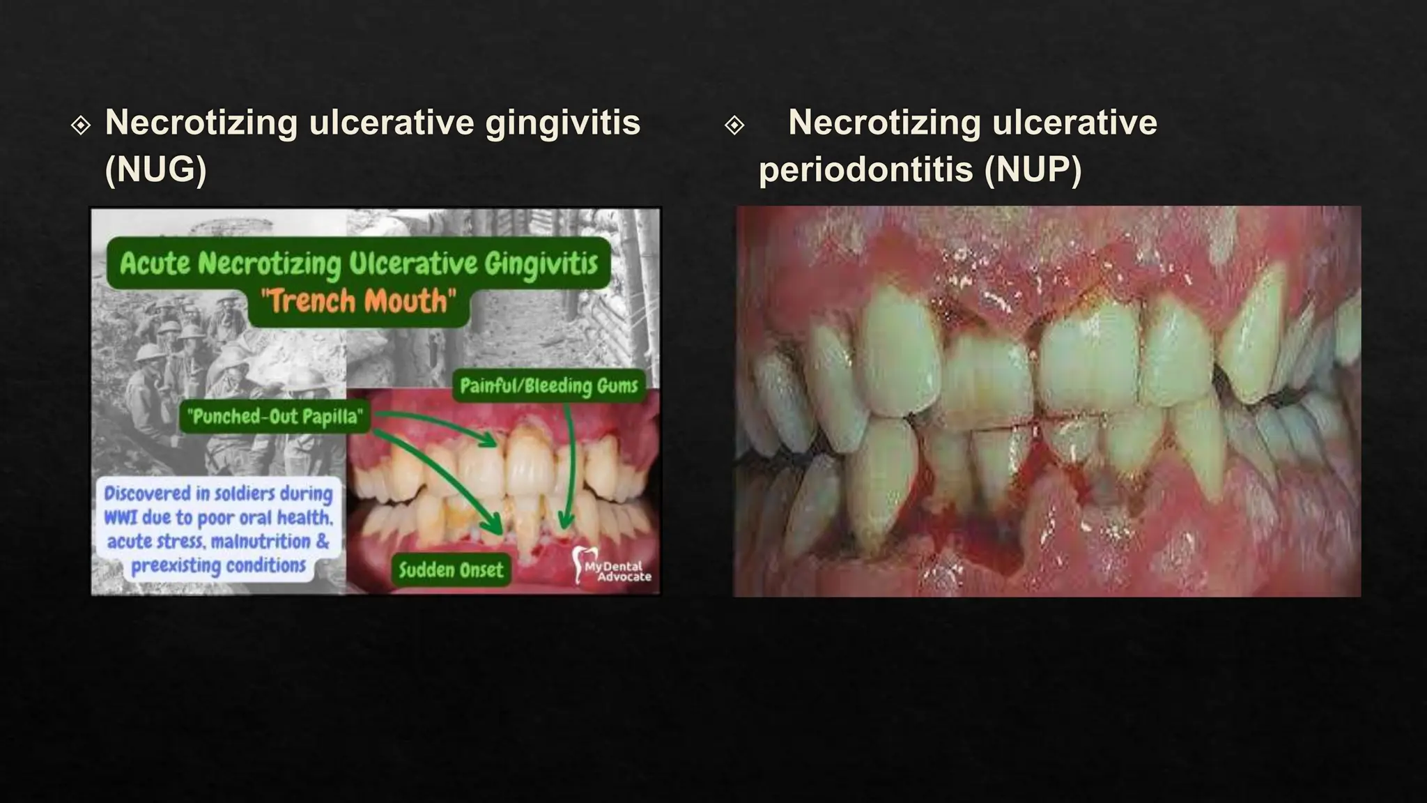 Classification of periodontitis | PPT