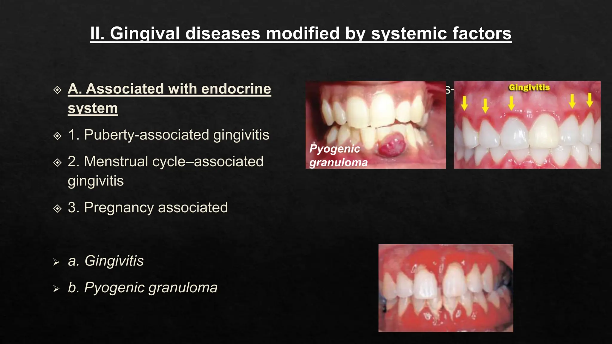 Classification of periodontitis | PPT