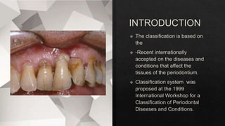 Classification of periodontitis | PPT