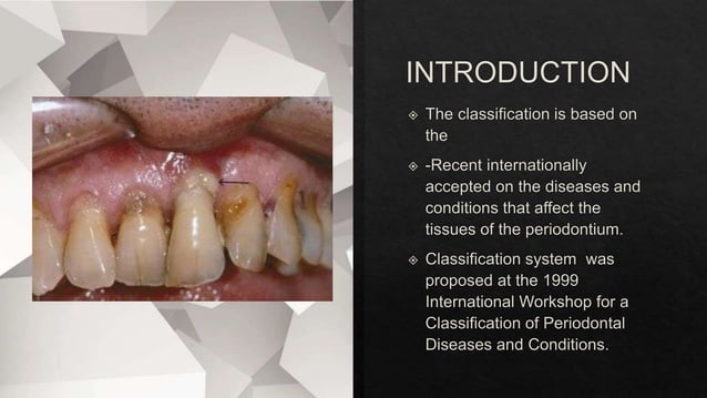 Classification of periodontitis | PPTX