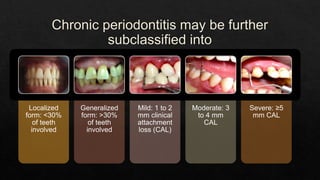 Classification of periodontitis | PPTX