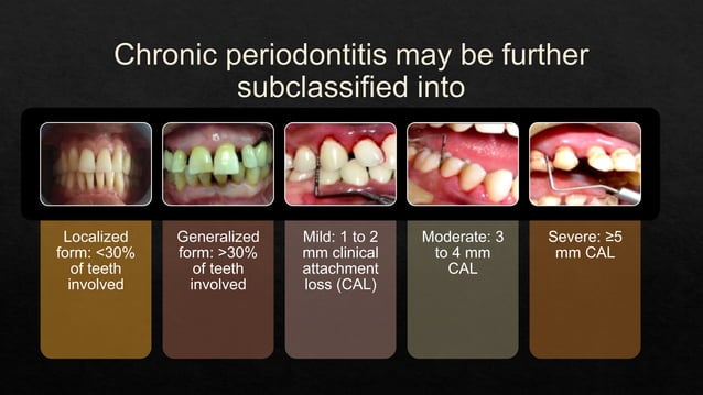 Classification of periodontitis | PPT