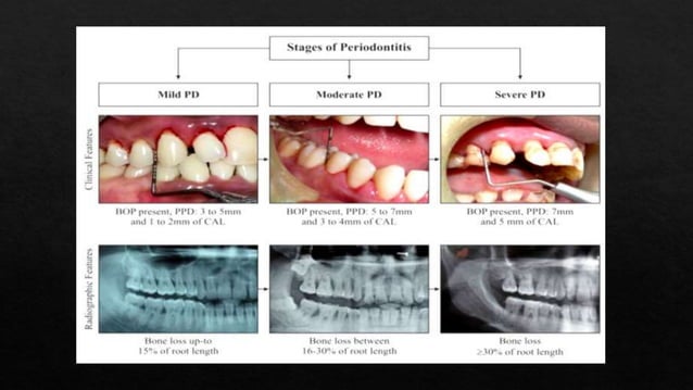 Classification of periodontitis | PPTX