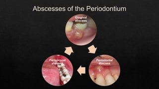 Classification of periodontitis | PPTX