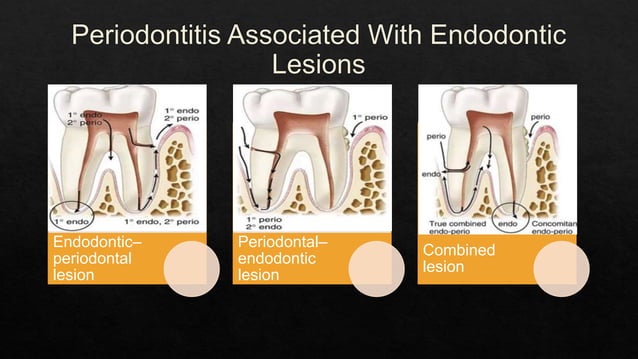 Classification of periodontitis | PPTX