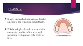 CLASSIFICATION OF REMOVABLE PARTIAL DENTURE.pptx