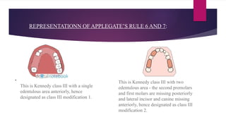 CLASSIFICATION OF REMOVABLE PARTIAL DENTURE.pptx
