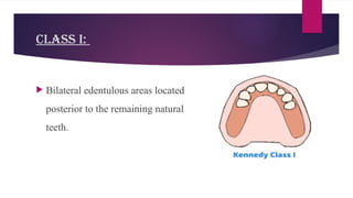 CLASSIFICATION OF REMOVABLE PARTIAL DENTURE.pptx
