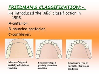 CLASSIFICATION OF RPD.ppt