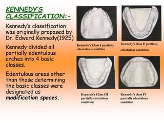 CLASSIFICATION OF RPD.ppt