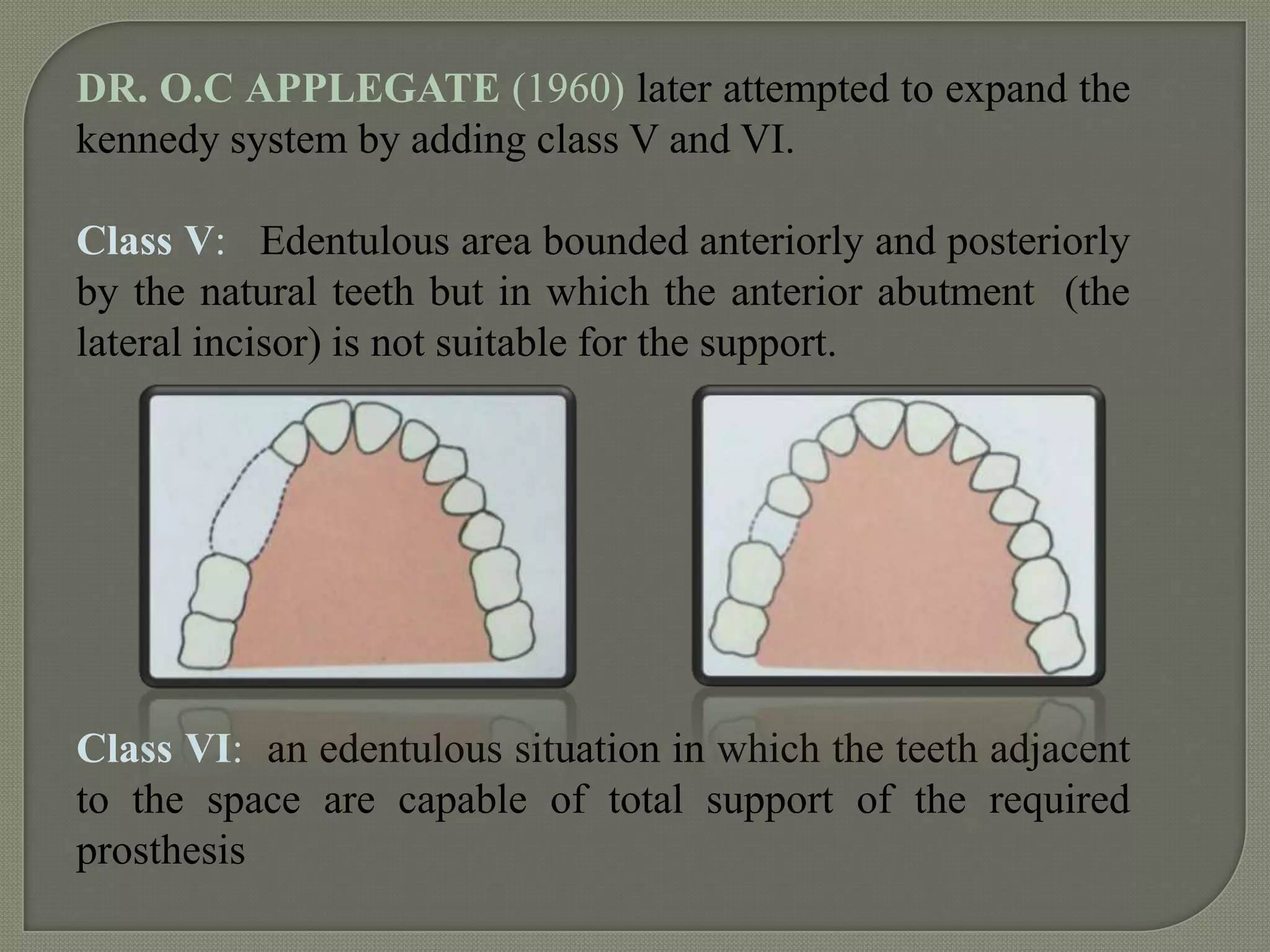 Classification of rpd | PPTX
