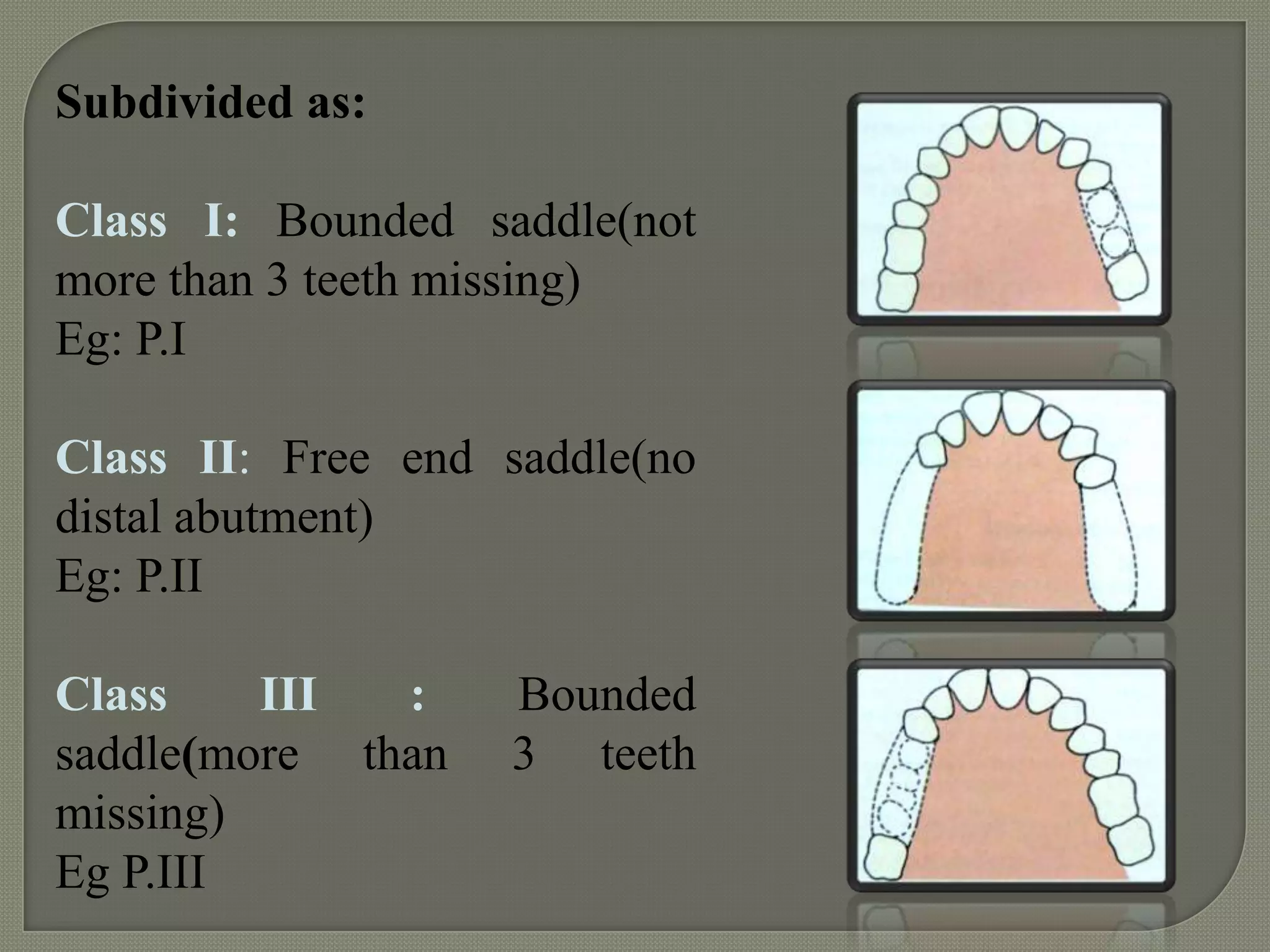 Classification of rpd | PPTX
