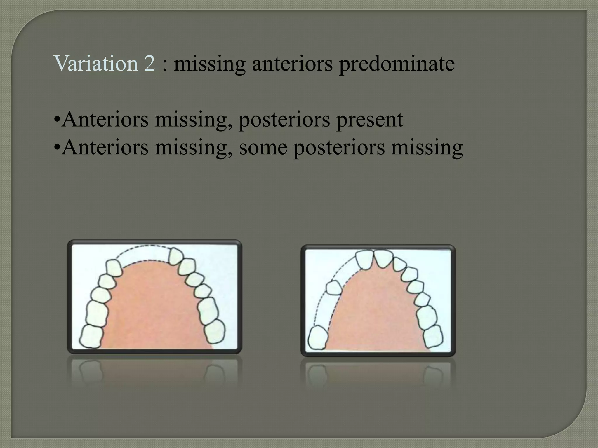 Classification of rpd | PPTX
