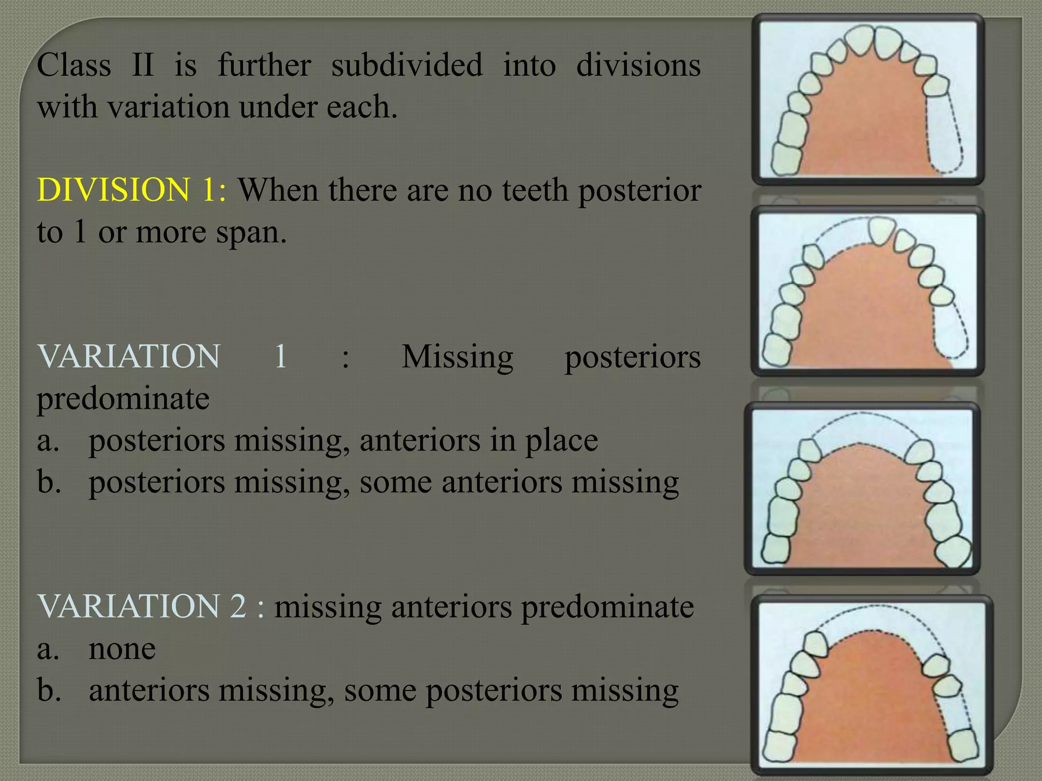 Classification of rpd | PPTX