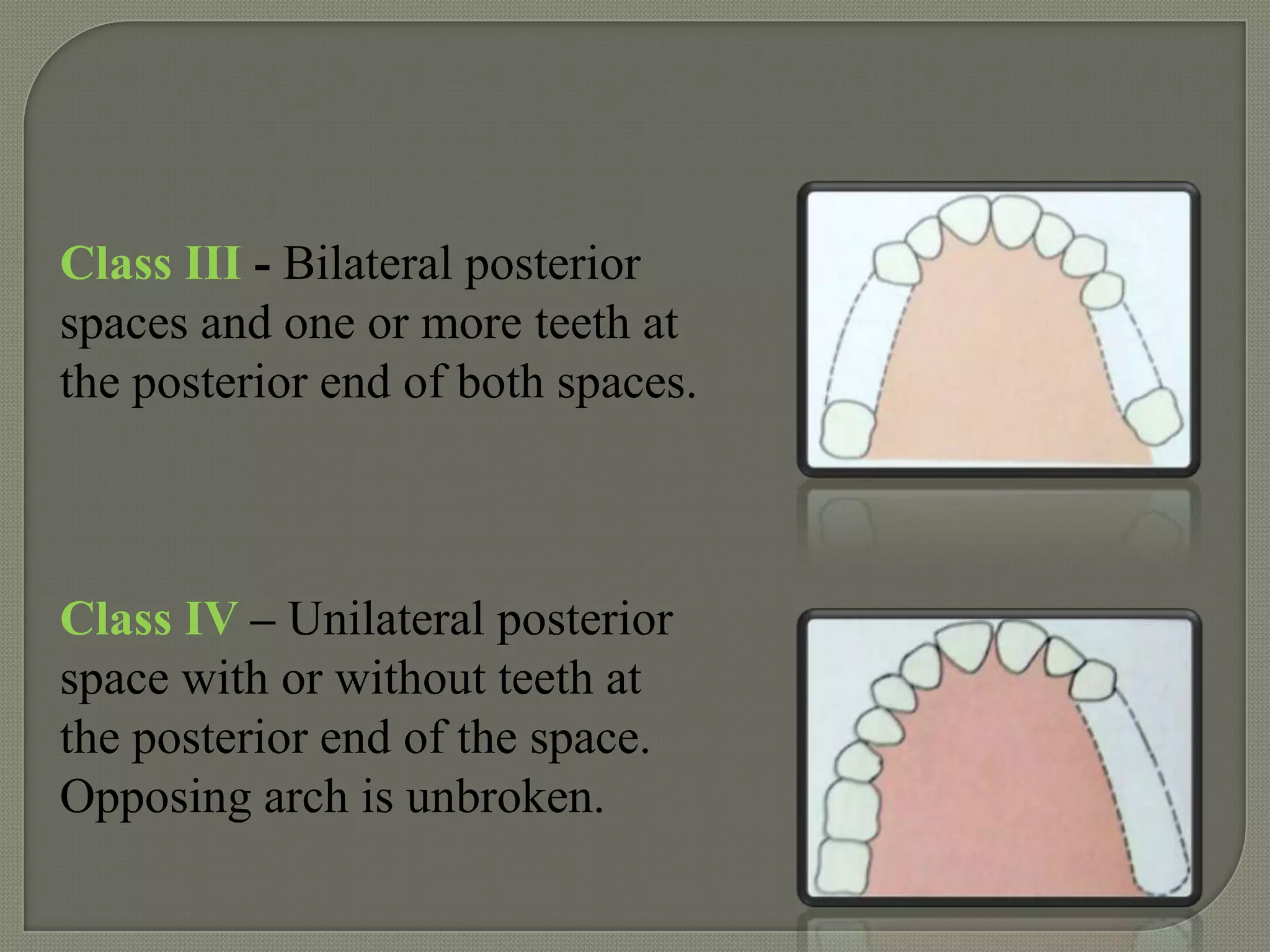Classification of rpd | PPTX