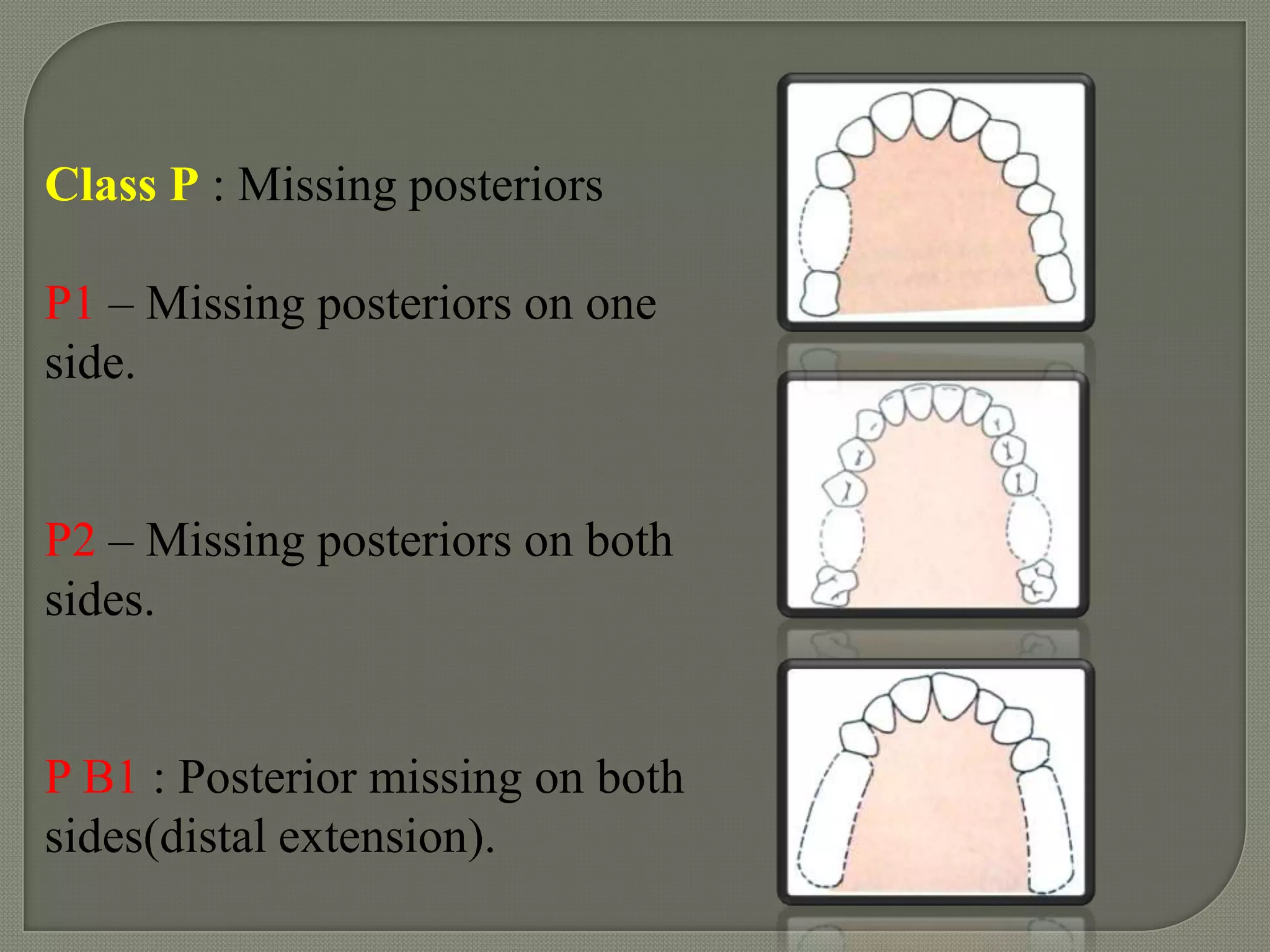 Classification of rpd | PPTX