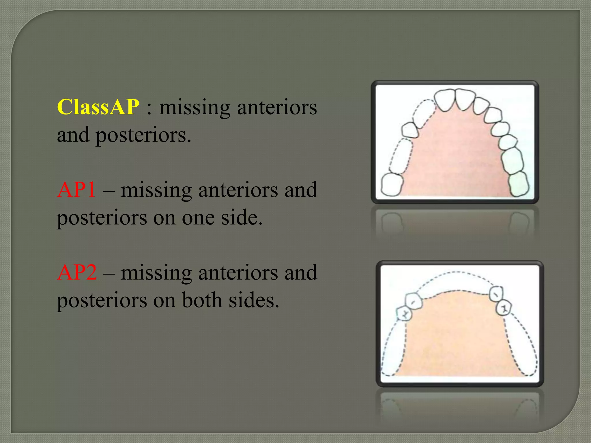 Classification of rpd | PPTX
