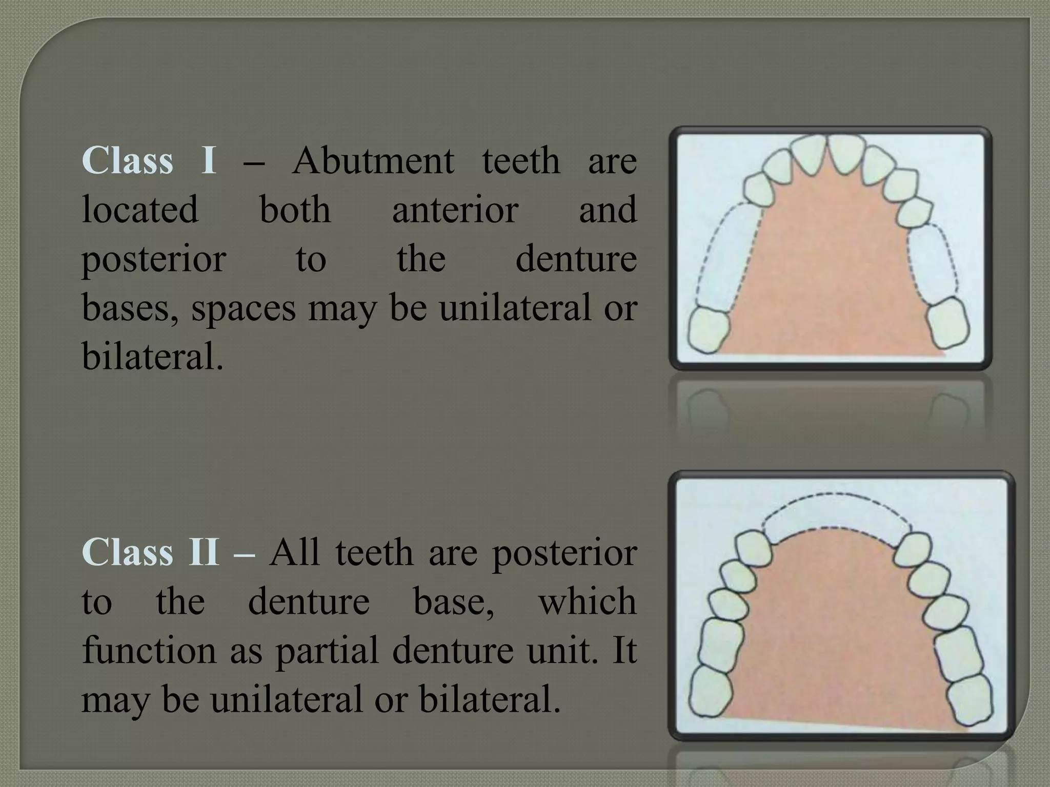 Classification of rpd | PPTX