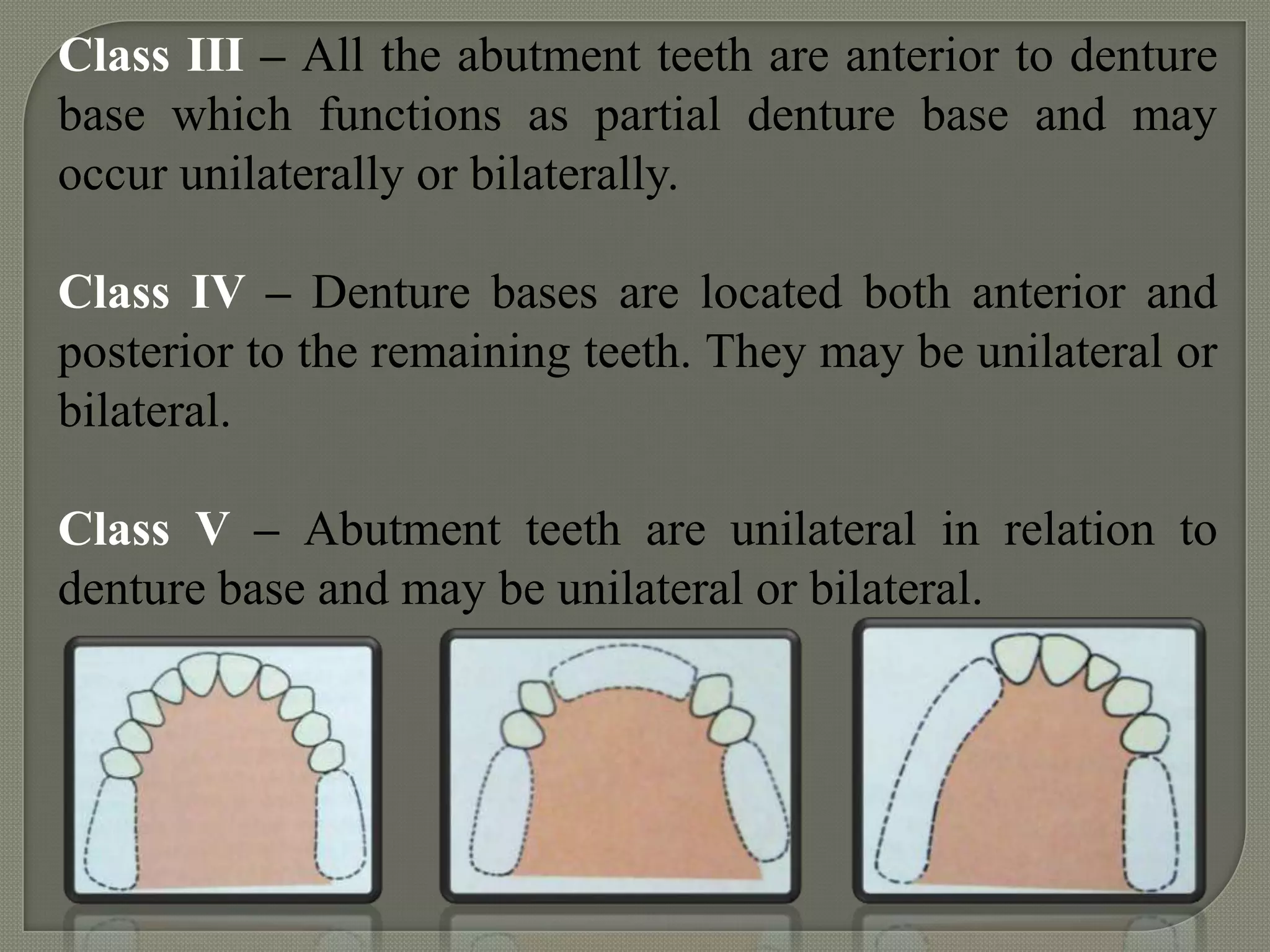 Classification of rpd | PPTX