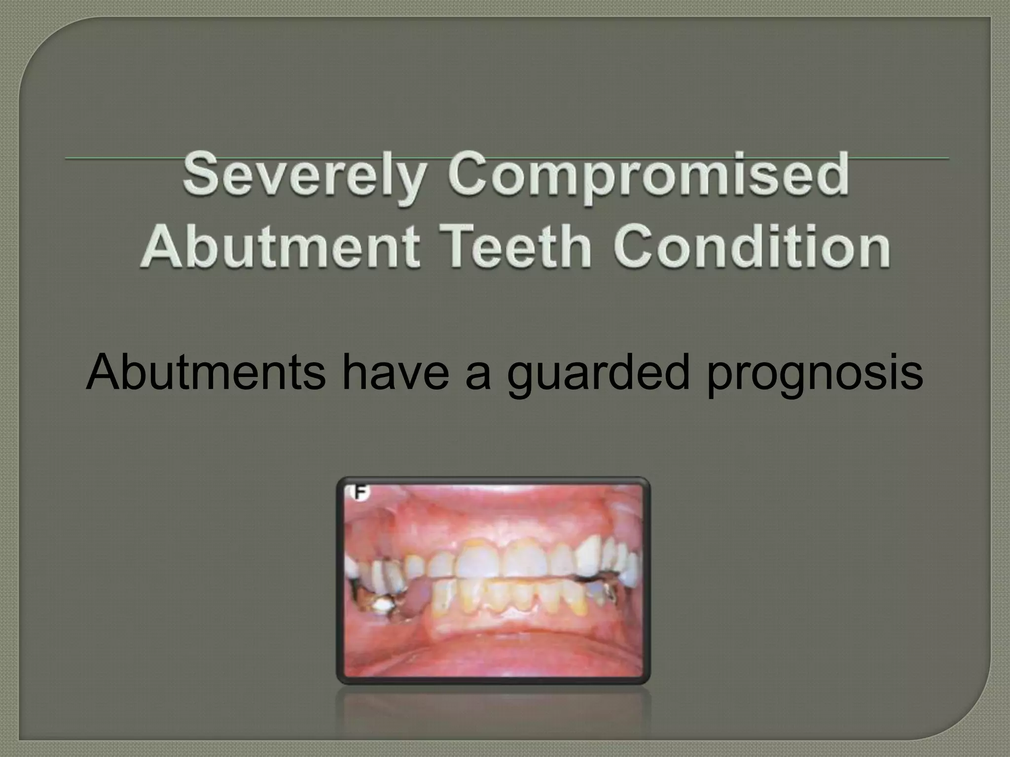 Classification of rpd | PPTX