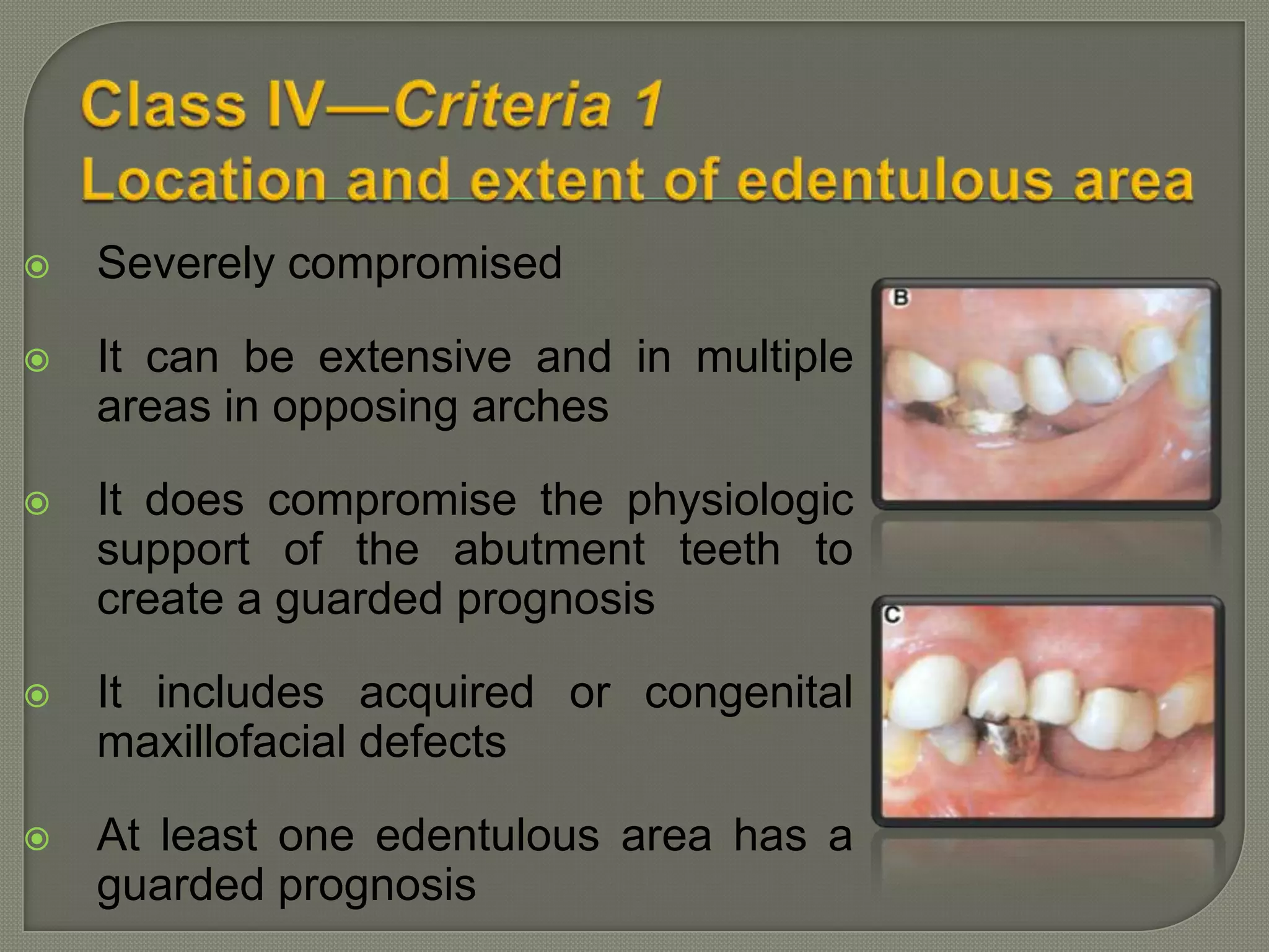 Classification of rpd | PPTX