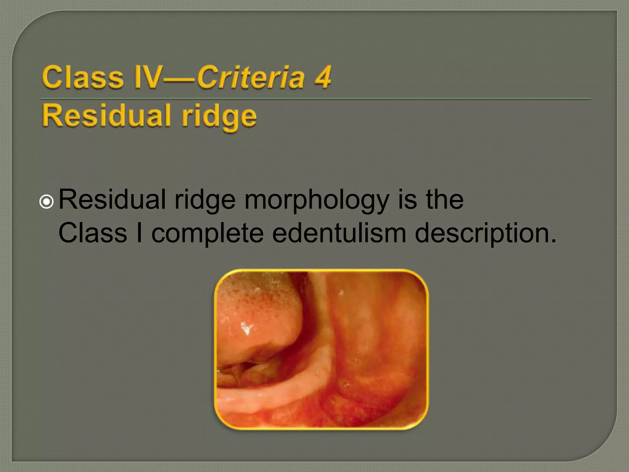 Classification of rpd | PPTX