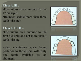 Classification of rpd | PPTX