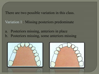 Classification of rpd | PPTX
