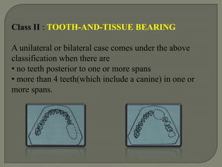 Classification of rpd | PPTX
