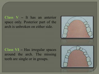 Classification of rpd | PPTX
