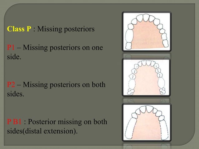 Classification of rpd | PPTX | Dental Health | Diseases and Conditions