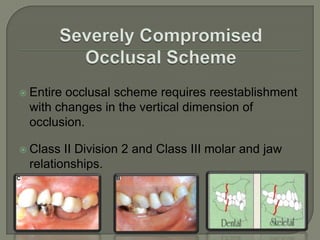 Classification of rpd | PPTX