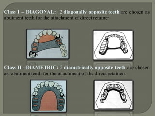Classification of rpd | PPTX