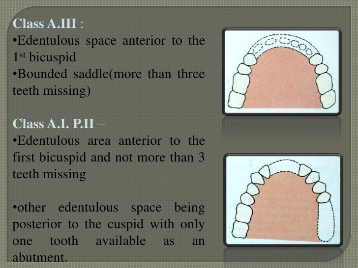 Classification of rpd