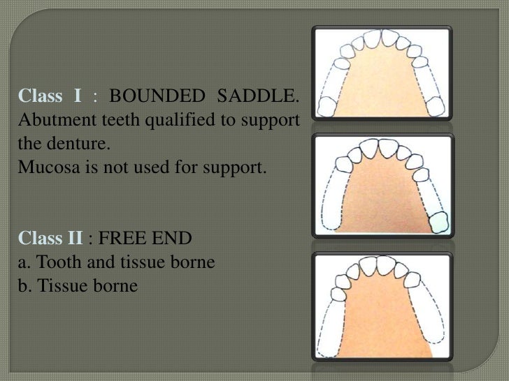 Classification of rpd