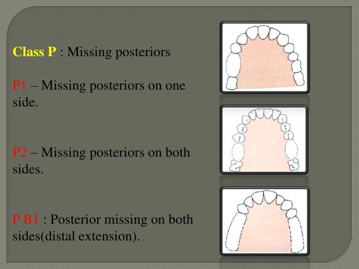 Classification of rpd