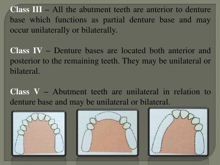 Classification of rpd