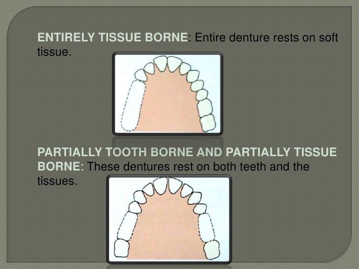 Classification of rpd