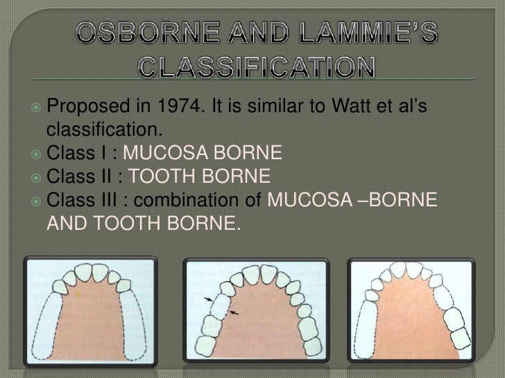 Classification of rpd