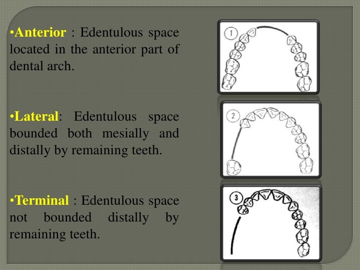 Classification of rpd